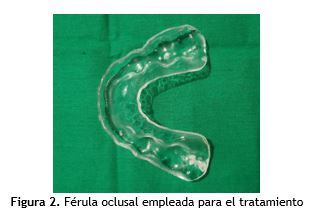 Férula oclusal como alternativa de tratamiento para el bruxismo | Cruz ...